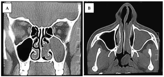 Prelacrimal Recess Approach in Unilateral Maxillary Sinus Lesions: What ...