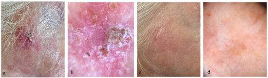 Medicina | Free Full-Text | Tirbanibulin 1% Ointment for Actinic ...