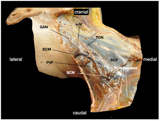 Continuous Interscalene Brachial Plexus Blocks: An Anatomical Challenge ...