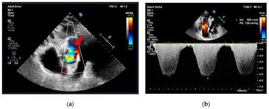 Acquired Cardiovascular Diseases in Patients with Pulmonary ...