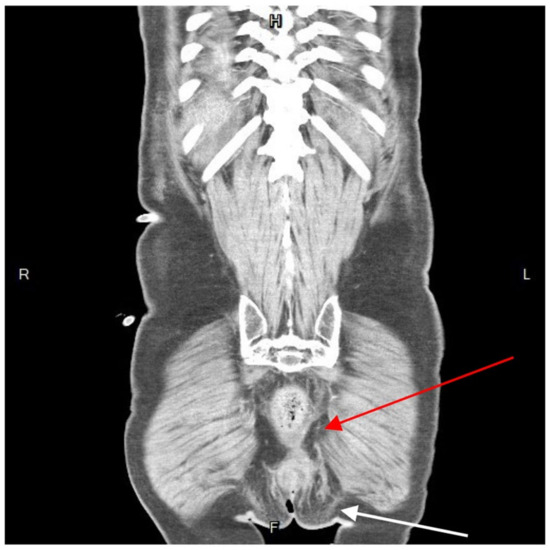 Perirectal Abscess with Anterior Extension to the Extraperitoneum and ...