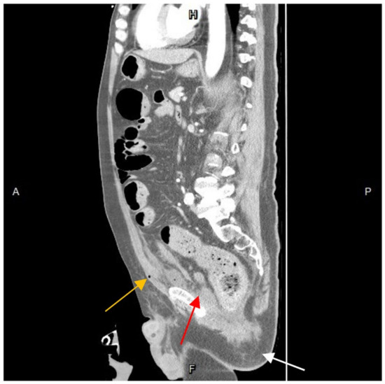 Perirectal Abscess with Anterior Extension to the Extraperitoneum and ...