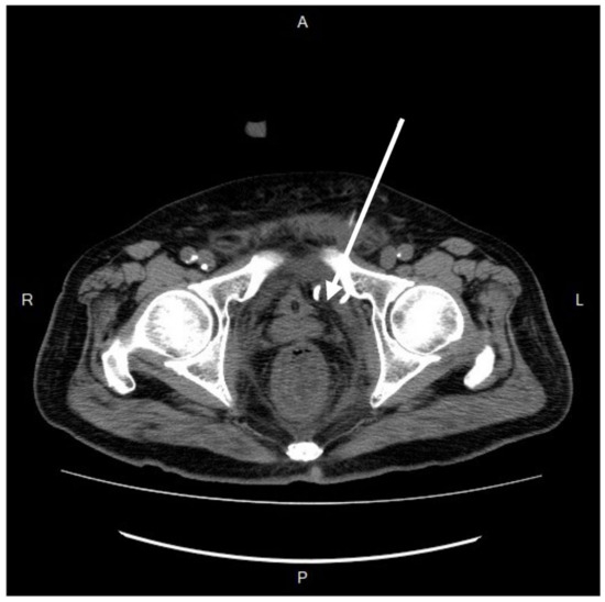 Perirectal Abscess with Anterior Extension to the Extraperitoneum and ...