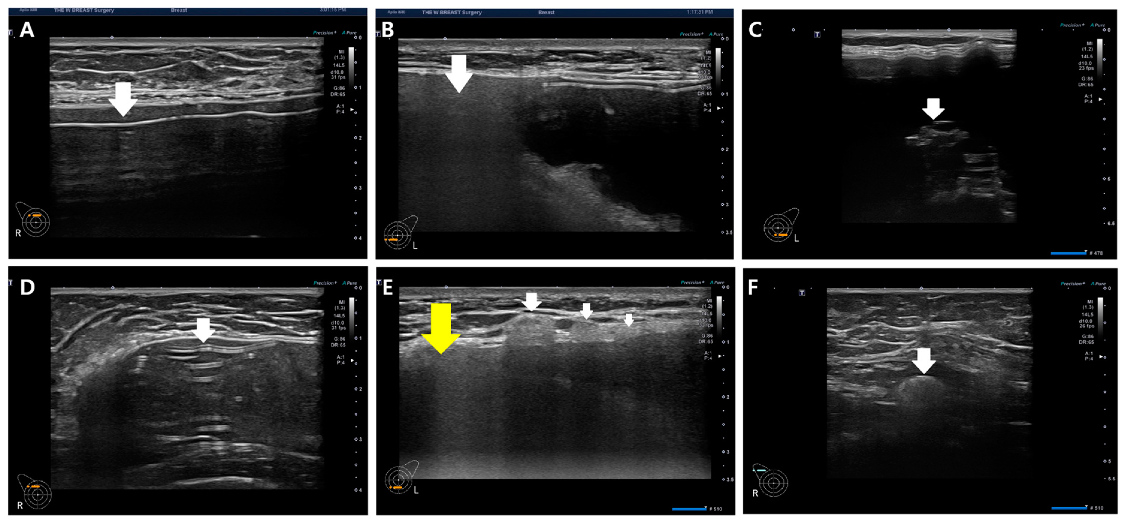 Exploration of Point-of-Care Ultrasonography for Silicone Breast ...