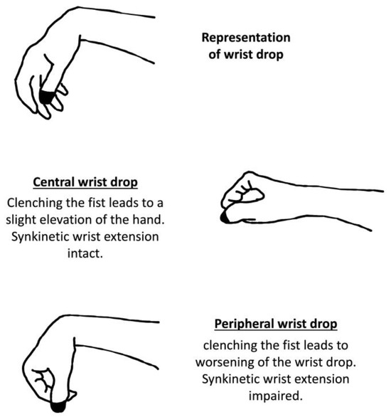 A Narrative Review of Stroke of Cortical Hand Knob Area