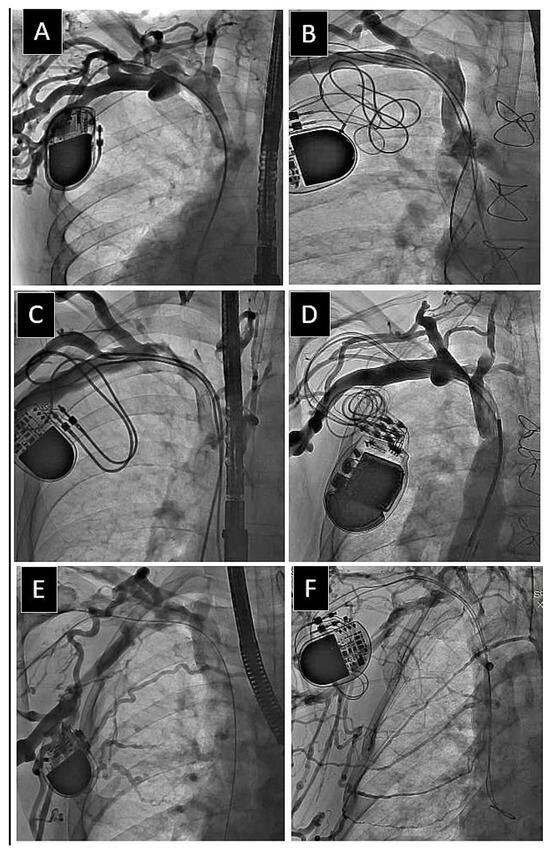 Multilevel Venous Obstruction in Patients with Cardiac Implantable ...