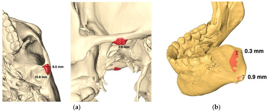 Medicina | Free Full-Text | Virtual Surgical Planning for ...