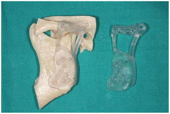 Medicina | Free Full-Text | Virtual Surgical Planning for ...