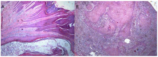 Multiple Keratoacanthoma-like Syndromes: Case Report and Literature Review