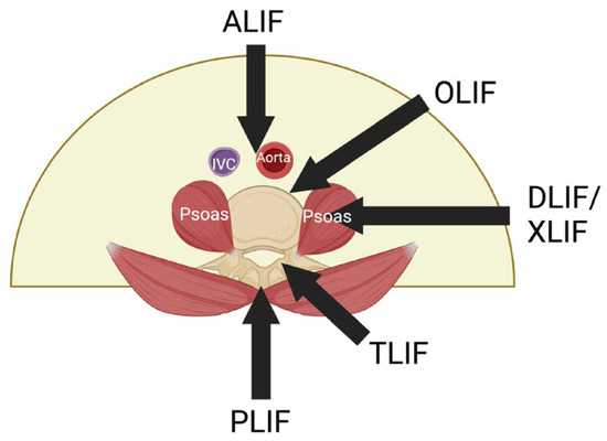 The Evolution of Lateral Lumbar Interbody Fusion: A Journey from Past ...