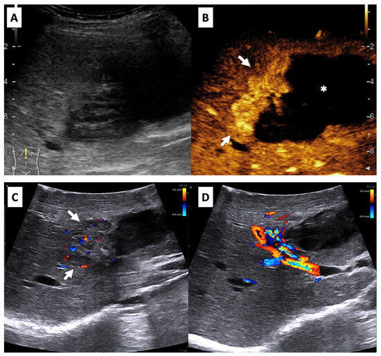 Primary Liver Perivascular Epithelioid Cell Tumor (PEComa): Case Report ...