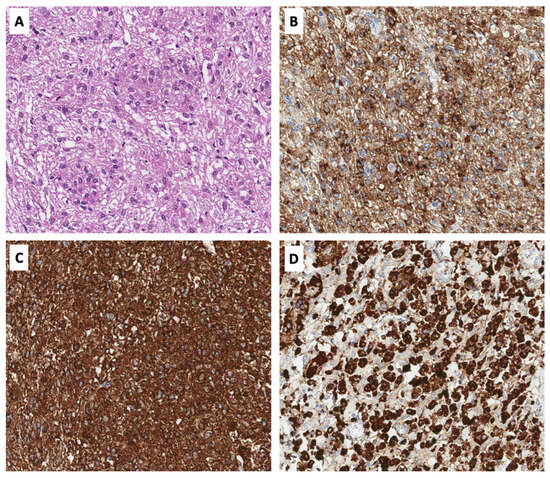 Primary Liver Perivascular Epithelioid Cell Tumor (PEComa): Case Report ...