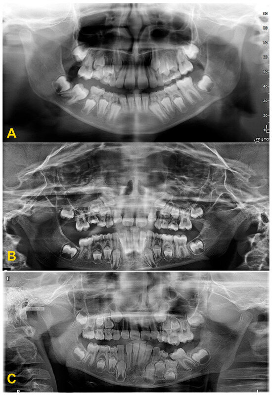 Infraocclusion in the Primary and Permanent Dentition—A Narrative Review