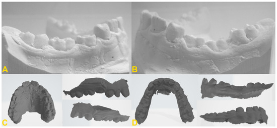 Infraocclusion in the Primary and Permanent Dentition—A Narrative Review