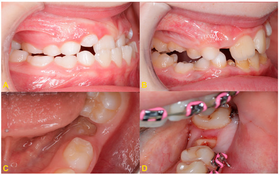 Medicina | Free Full-Text | Infraocclusion in the Primary and Permanent ...