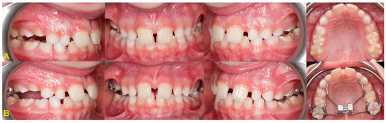 Infraocclusion in the Primary and Permanent Dentition—A Narrative Review