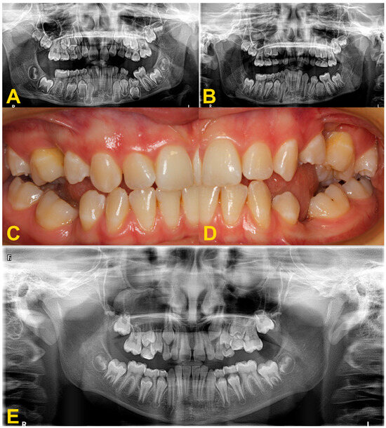 Infraocclusion in the Primary and Permanent Dentition—A Narrative Review