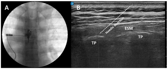 Transforaminal Epidural Block and Erector Spinae Plane Block to Manage ...