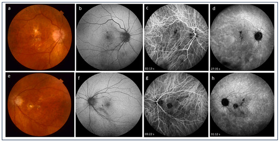 Diagnostic Challenges in Inflammatory Choroidal Neovascularization