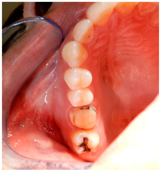 New Perspectives in Third Molar Auto-Transplantation: Literature Review ...