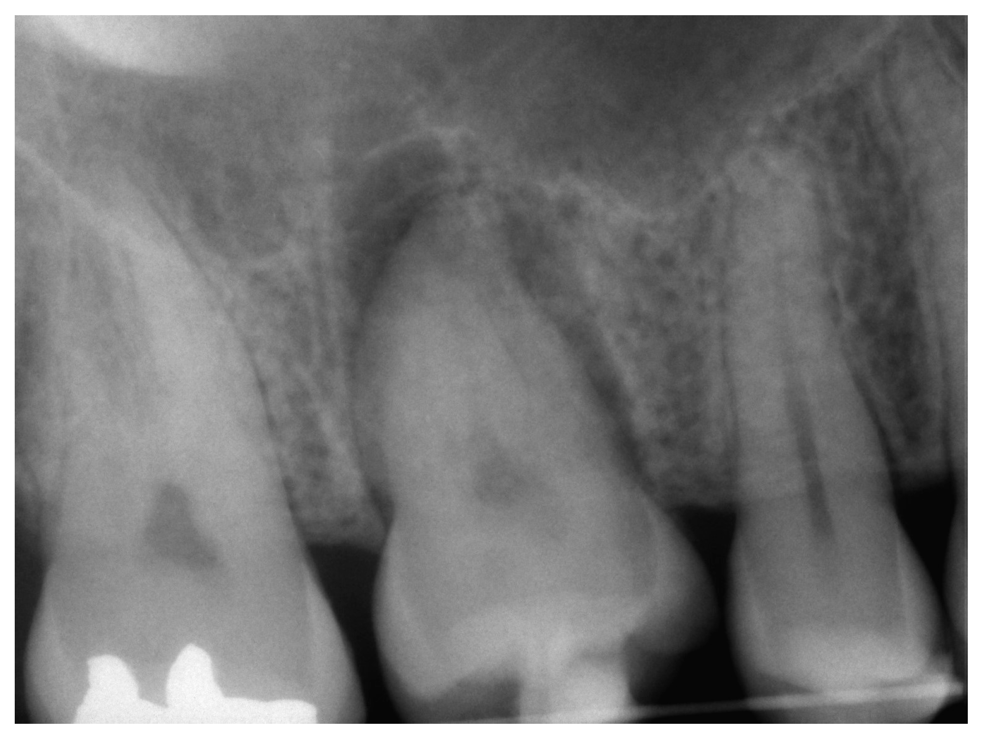 New Perspectives in Third Molar Auto-Transplantation: Literature Review ...