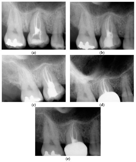 New Perspectives in Third Molar Auto-Transplantation: Literature Review ...