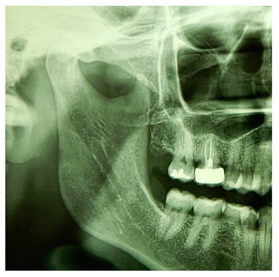 New Perspectives in Third Molar Auto-Transplantation: Literature Review ...