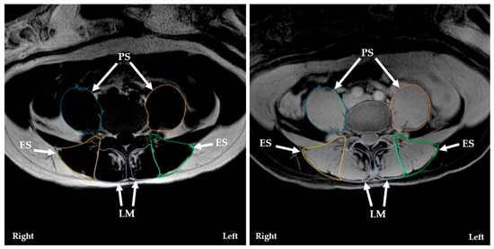 Paraspinal Muscle Changes in Individuals with and without Chronic Low ...