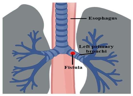 A Successful Treatment of Broncho-Esophageal Fistula with Esophageal ...