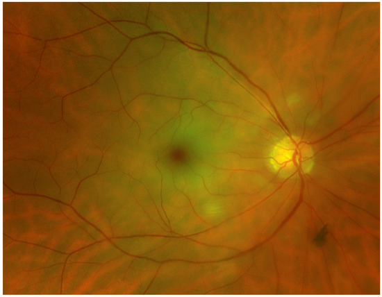 Aetiology, Diagnosis and Treatment of Arterial Occlusions of the Retina ...