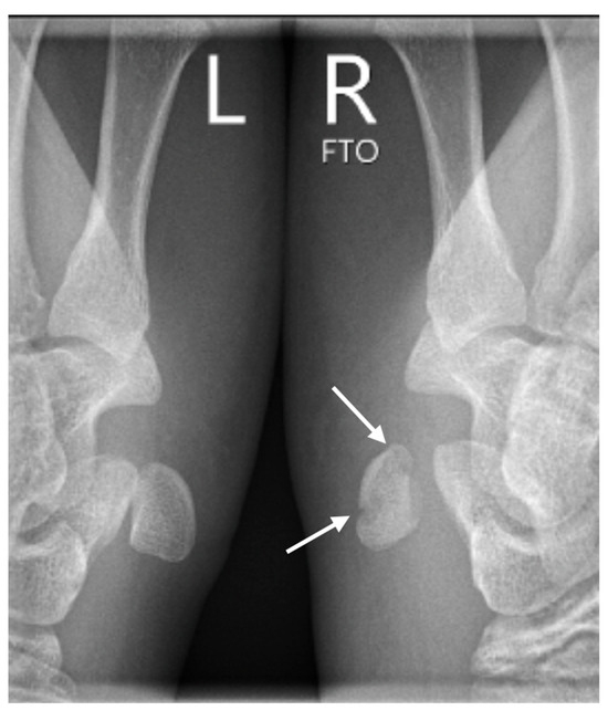 Fracture Dislocation of the Pisiform Bone in 14-Year-Old Boy—A Case Report