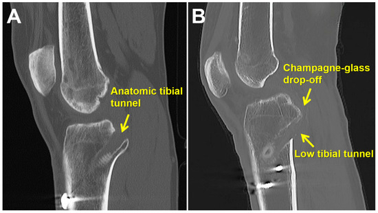 Anatomic versus Low Tibial Tunnel in Double-Bundle Posterior Cruciate Ligament Reconstruction ...