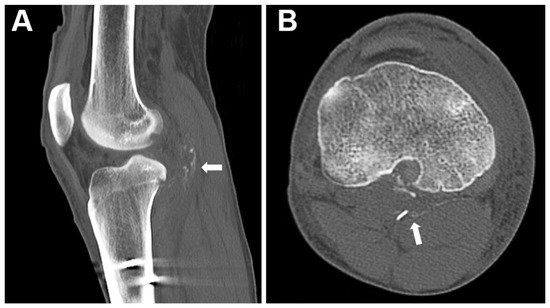 Anatomic versus Low Tibial Tunnel in Double-Bundle Posterior Cruciate ...