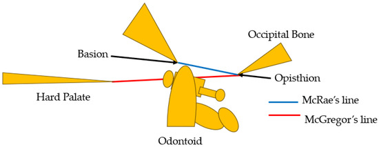 A Novel Technique for Basilar Invagination Treatment in a Patient with ...