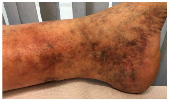 Medicina | Free Full-Text | Understanding CEAP Classification: Insights ...