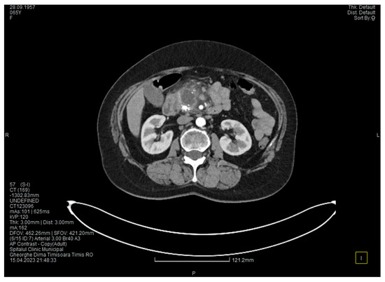 Pancreaticoduodenectomy with Anatomical Vascular Variant in Groove ...
