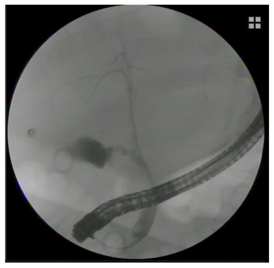 Endoscopic Gallbladder Drainage: A Comprehensive Review on Indications ...