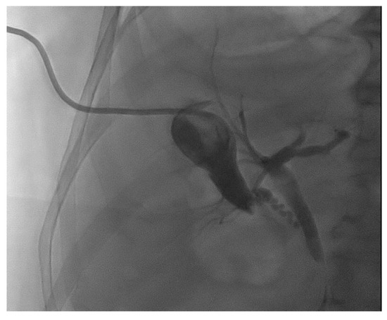 Endoscopic Gallbladder Drainage: A Comprehensive Review on Indications ...