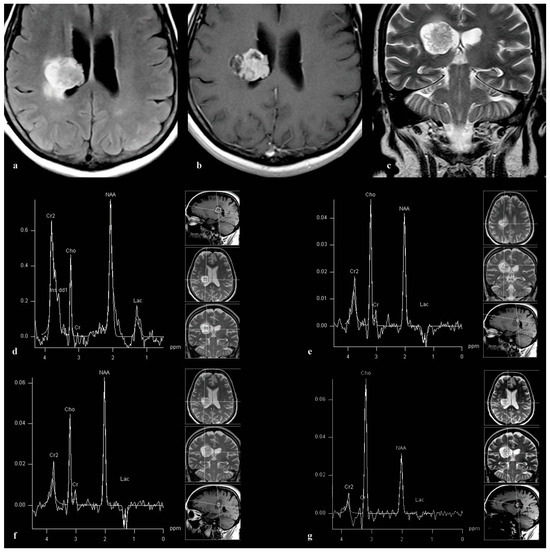 Peak Resembling N-acetylaspartate (NAA) on Magnetic Resonance ...