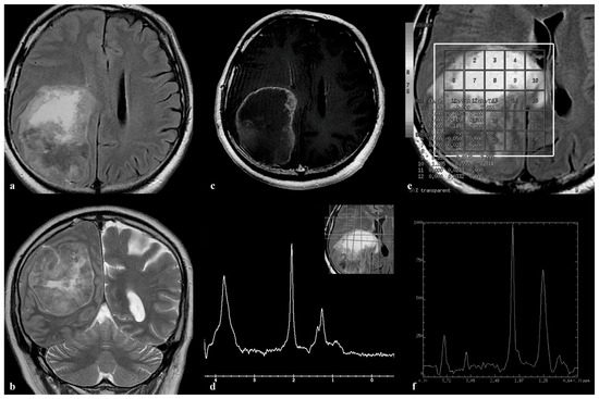 Peak Resembling N-acetylaspartate (NAA) on Magnetic Resonance ...