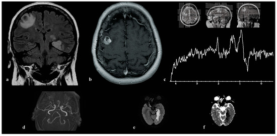 Peak Resembling N-acetylaspartate (NAA) on Magnetic Resonance ...
