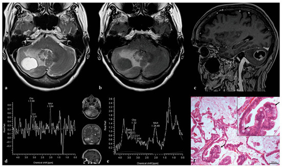 Peak Resembling N-acetylaspartate (NAA) on Magnetic Resonance ...