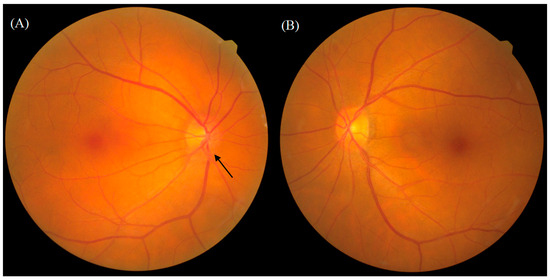 Rare Orbital Involvement Originating from Extranodal Marginal Zone Lymphoma