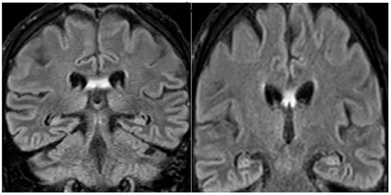 Autoimmune Encephalitis following Checkpoint Inhibitor Therapy in a ...