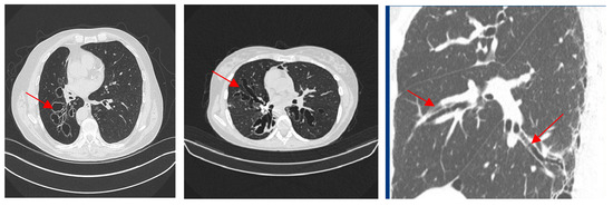 Phenotype and Clinicoradiological Differences in Multifocal and Focal ...
