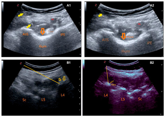 Comparison of the Analgesic Effect of Pericapsular Nerve Group Block ...