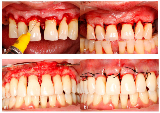 Healing of Periodontal Suprabony Defects following Treatment with Open ...