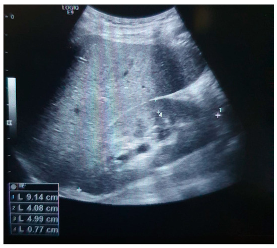 Diabetic Nephropathy, Retinopathy, and Functional Hypogonadism in a ...