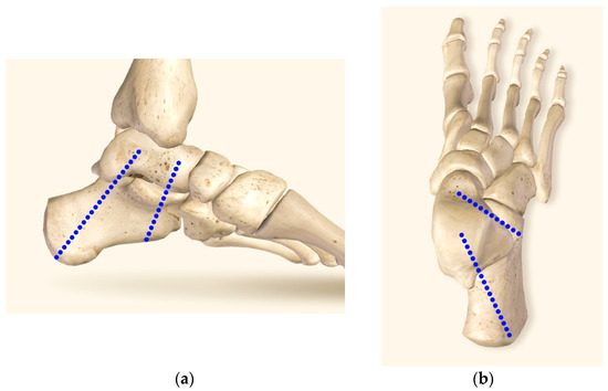 Medicina | Free Full-Text | Optimizing Subtalar Arthrodesis: A Human ...