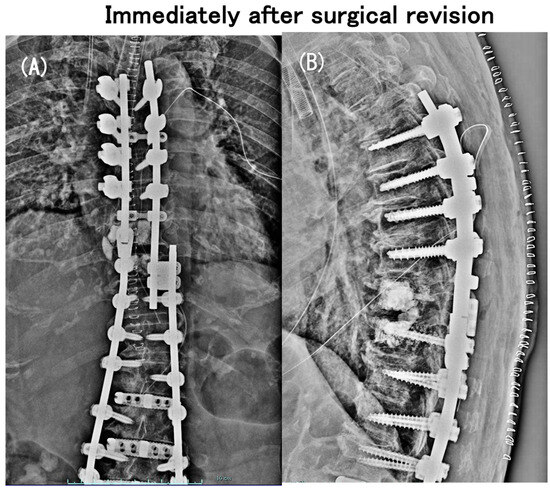 Can We Rely on Prophylactic Two-Level Vertebral Cement Augmentation in ...